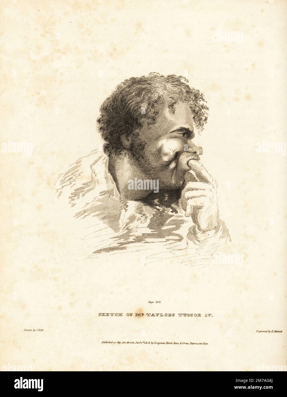 Sketch of mr taylors tumor no iv hi-res stock photography and images ...