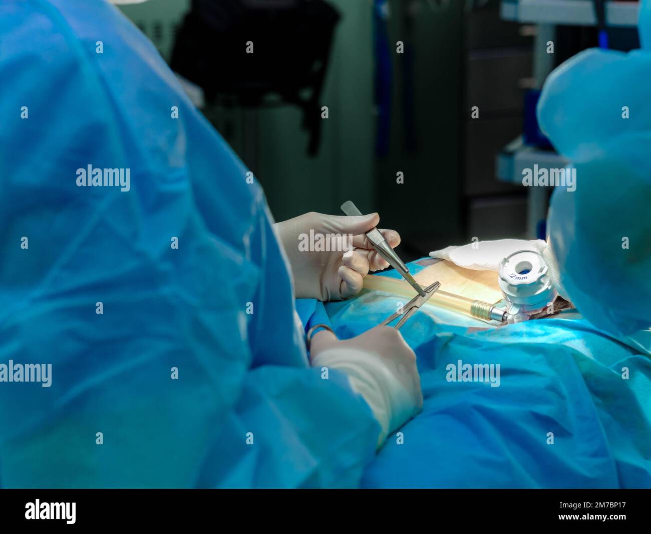 Fistula abdomen hi-res stock photography and images - Alamy