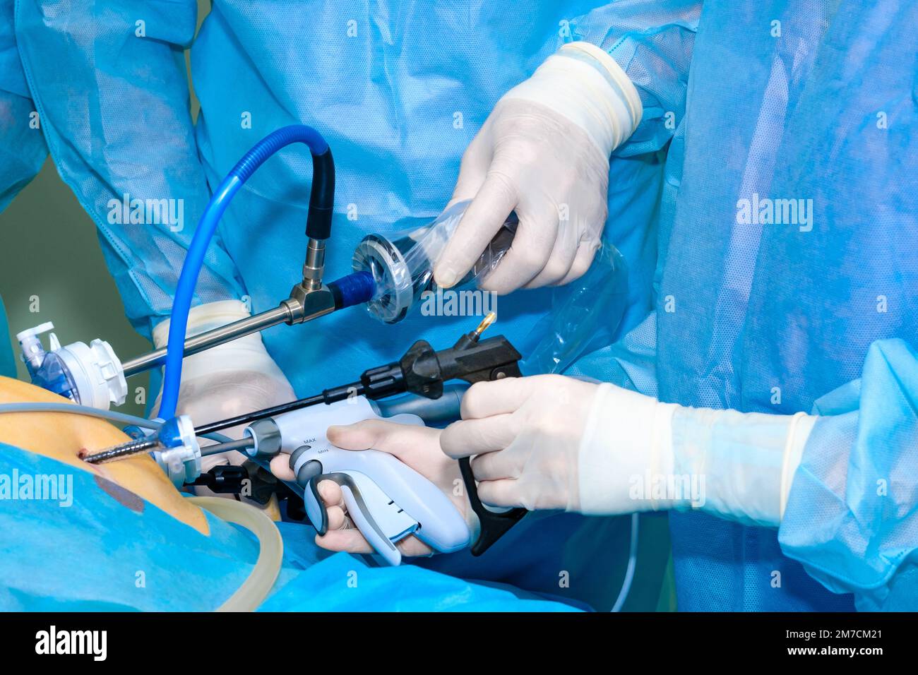 Fistula abdomen hi-res stock photography and images - Alamy