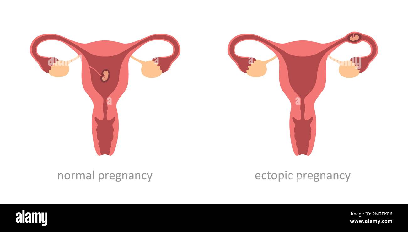 Womens Health Normal And Ectopic Pregnancy Embryo Stock Vector Image