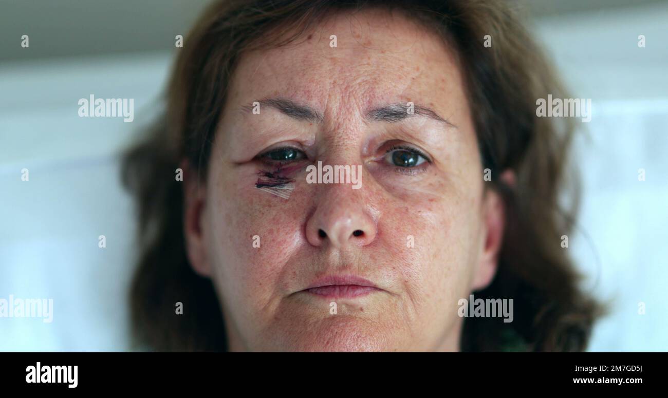 Older woman with bruise scar face opening eyes looking to camera Stock ...