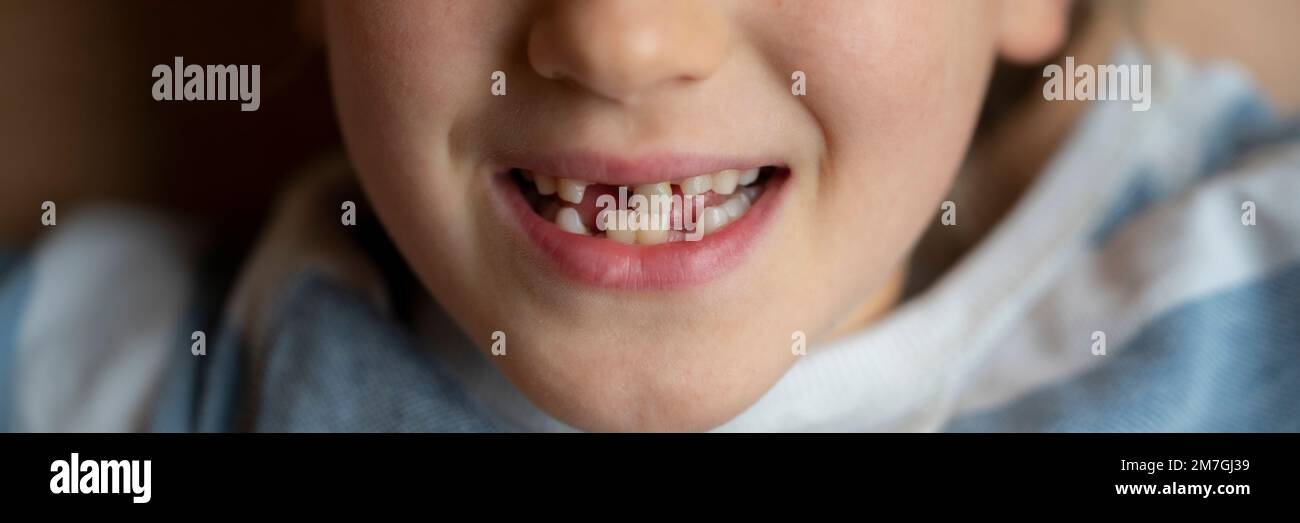 Wide closeup view image of a cute toddler boy smiling with three of his baby teeth missing Stock ...