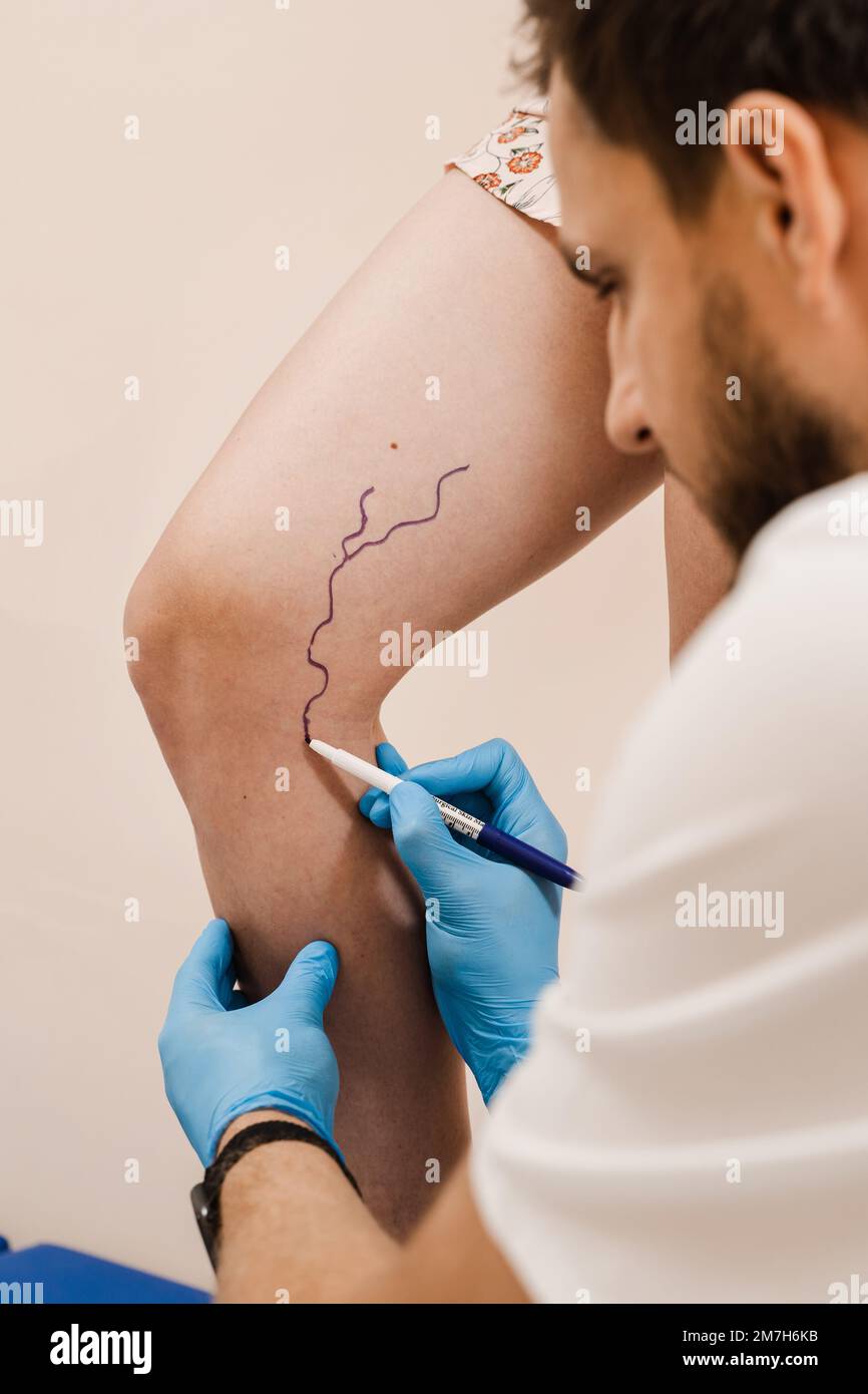 Vein markup. The phlebologist is marking legs before surgery to remove ...