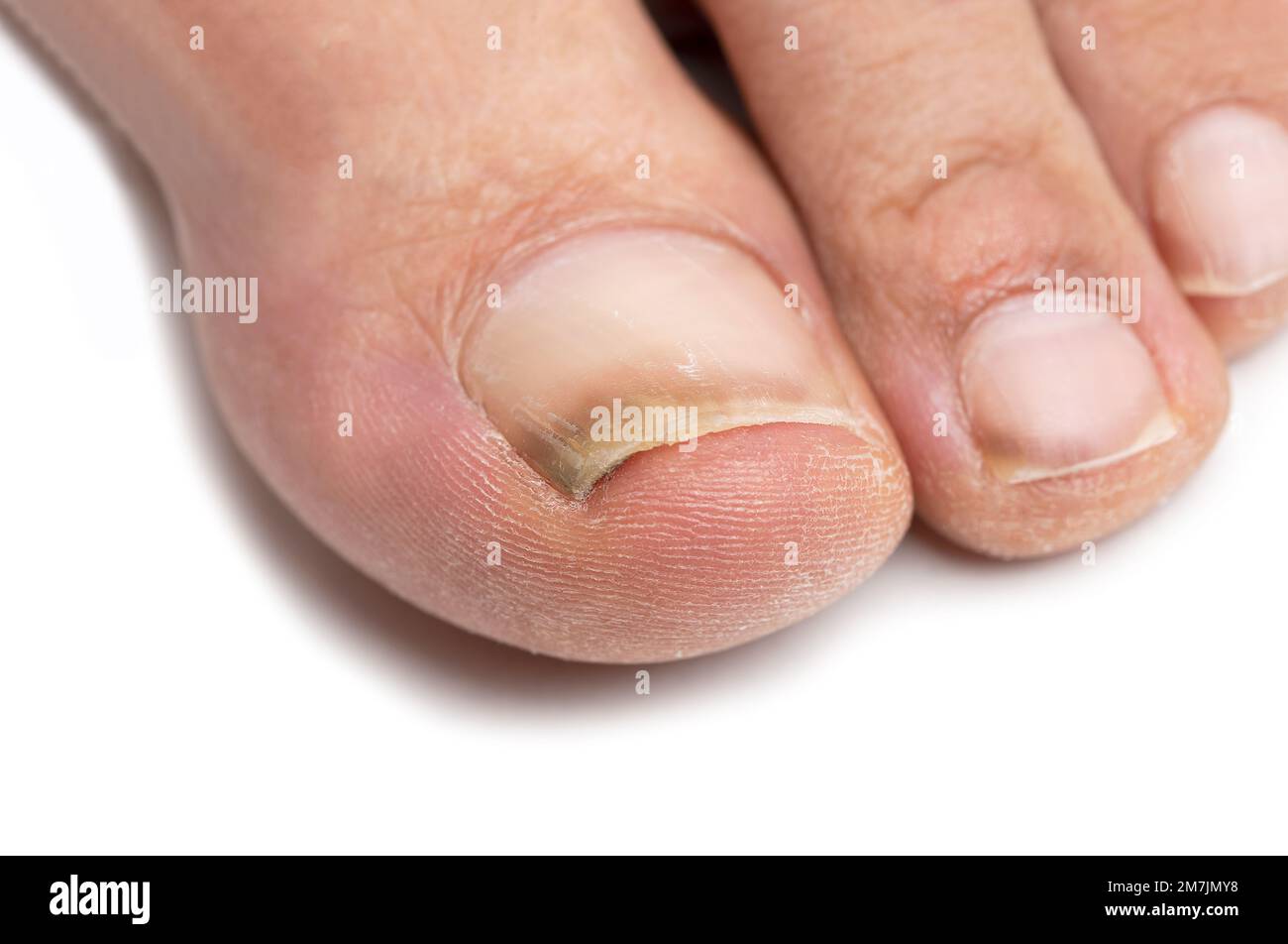Close up image of a finger with nail fungus infection Stock Photo - Alamy