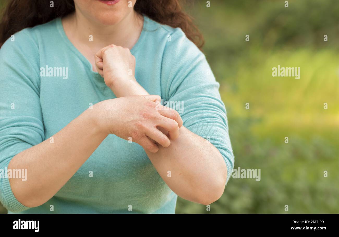 Fungal infection skin arm hi-res stock photography and images - Alamy