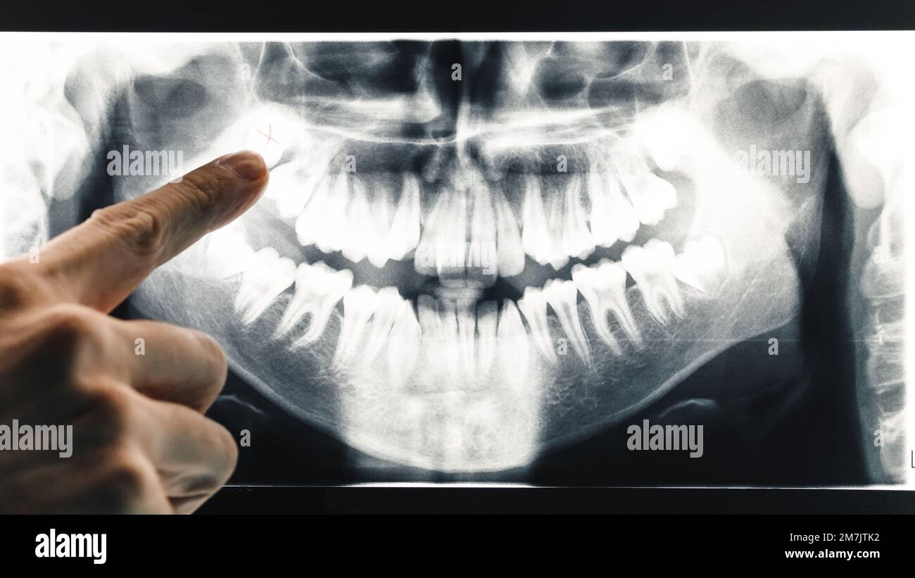 Ray in medicine dentistry hi-res stock photography and images - Alamy
