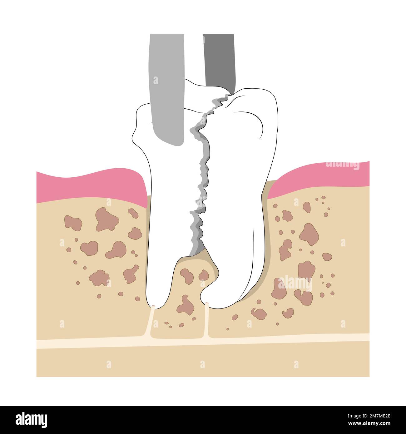 Removal of molar tooth crashed in the jaw. Surgical extraction of a ...