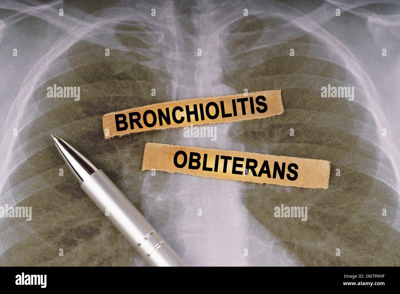 Medical concept. On a human chest x-ray, a pen and strips of paper labeled - bronchiolitis ...
