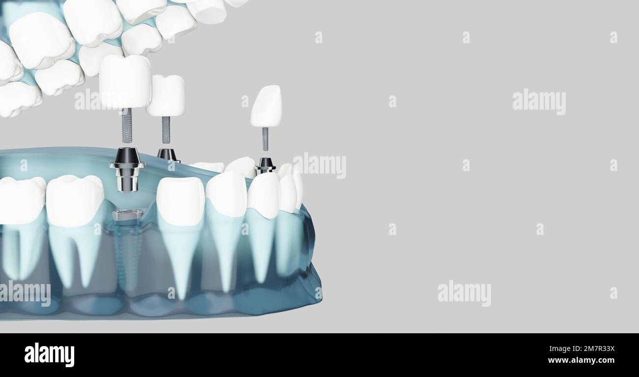 Component of Dental implants and copy space. Blue color transparent. 3d ...