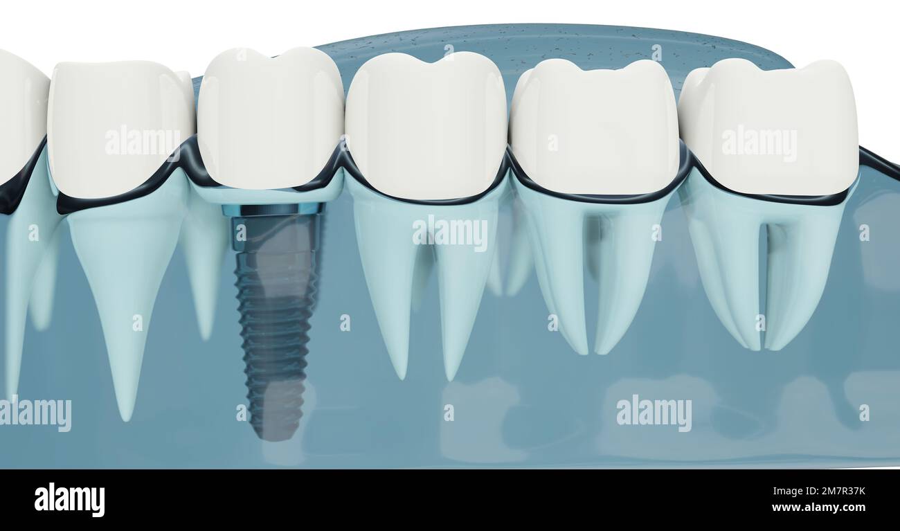 Close up Component of Dental implants. Blue color transparent. 3d ...