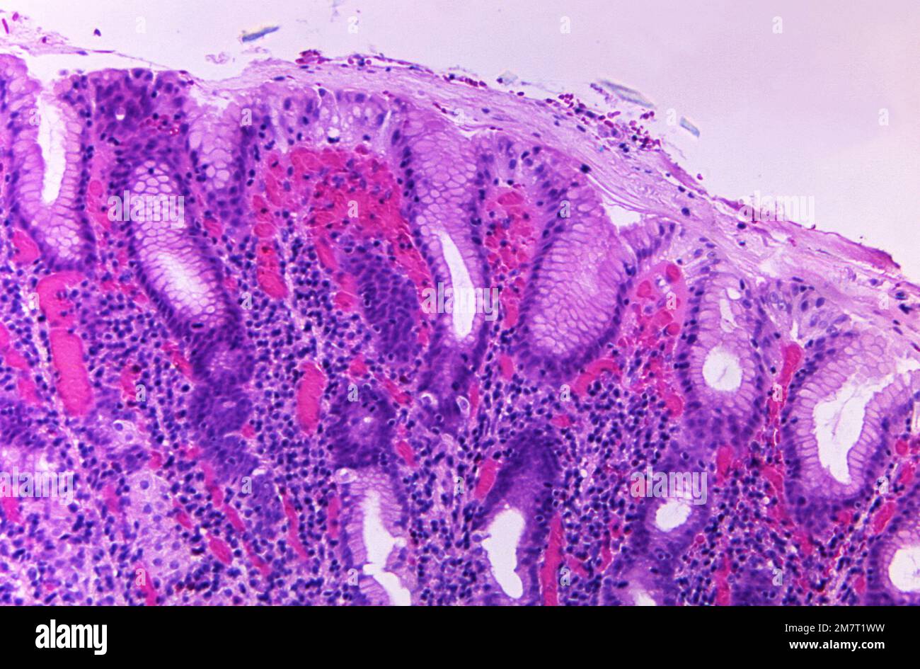 Gastric biopsy of a cholera patient, light micrograph Stock Photo - Alamy