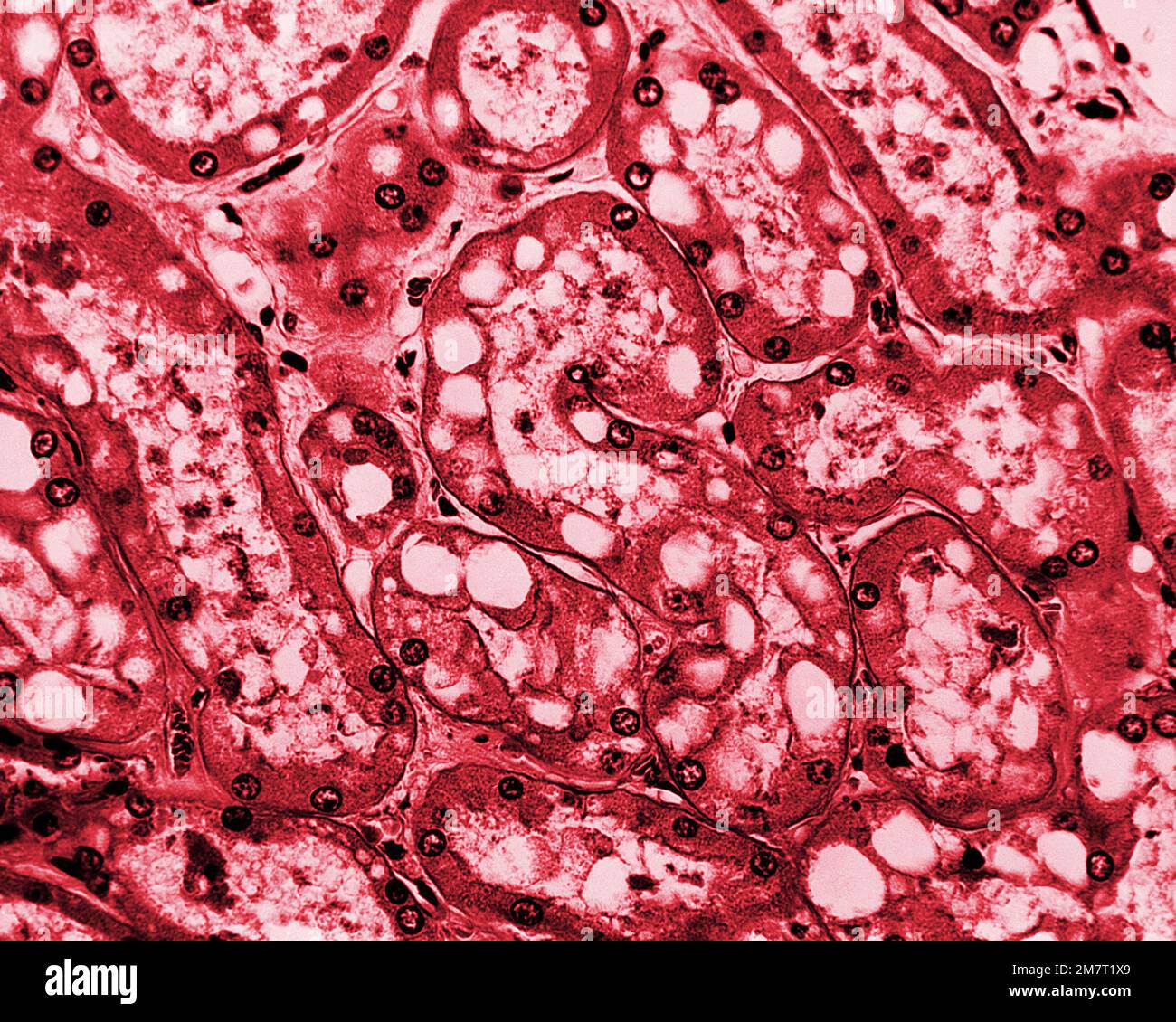 Hypokalemic nephropathy, light micrograph Stock Photo - Alamy