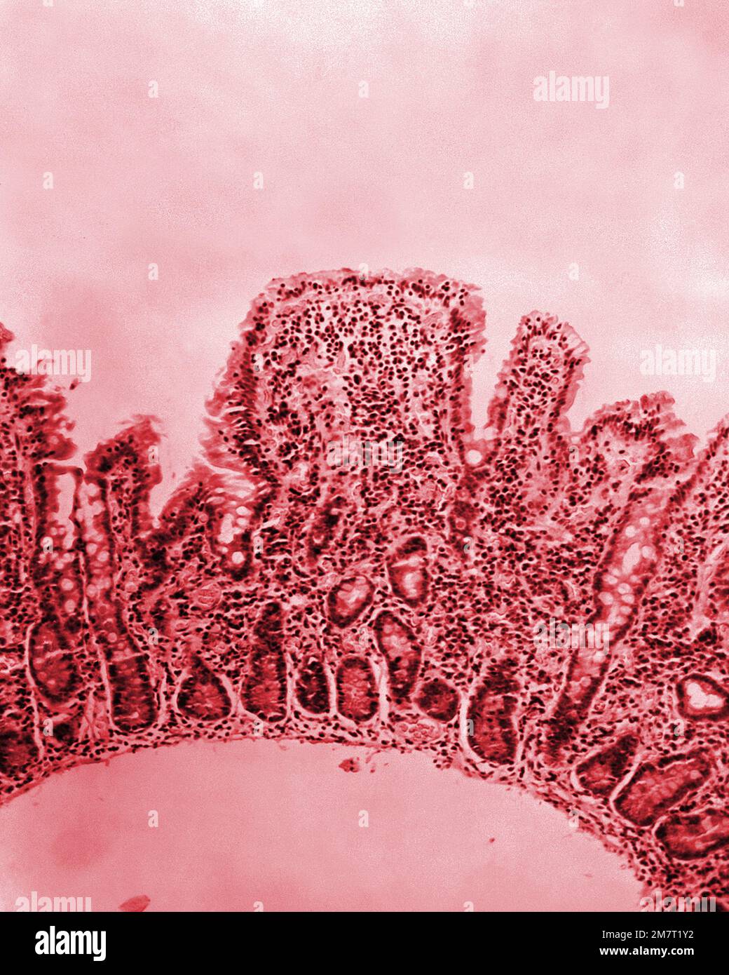 Small bowel tissue of a cholera patient, light micrograph Stock Photo ...