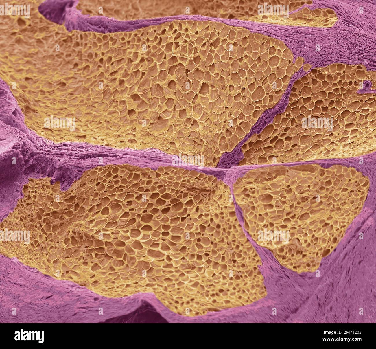 Tumour adipose tissue, SEM Stock Photo - Alamy