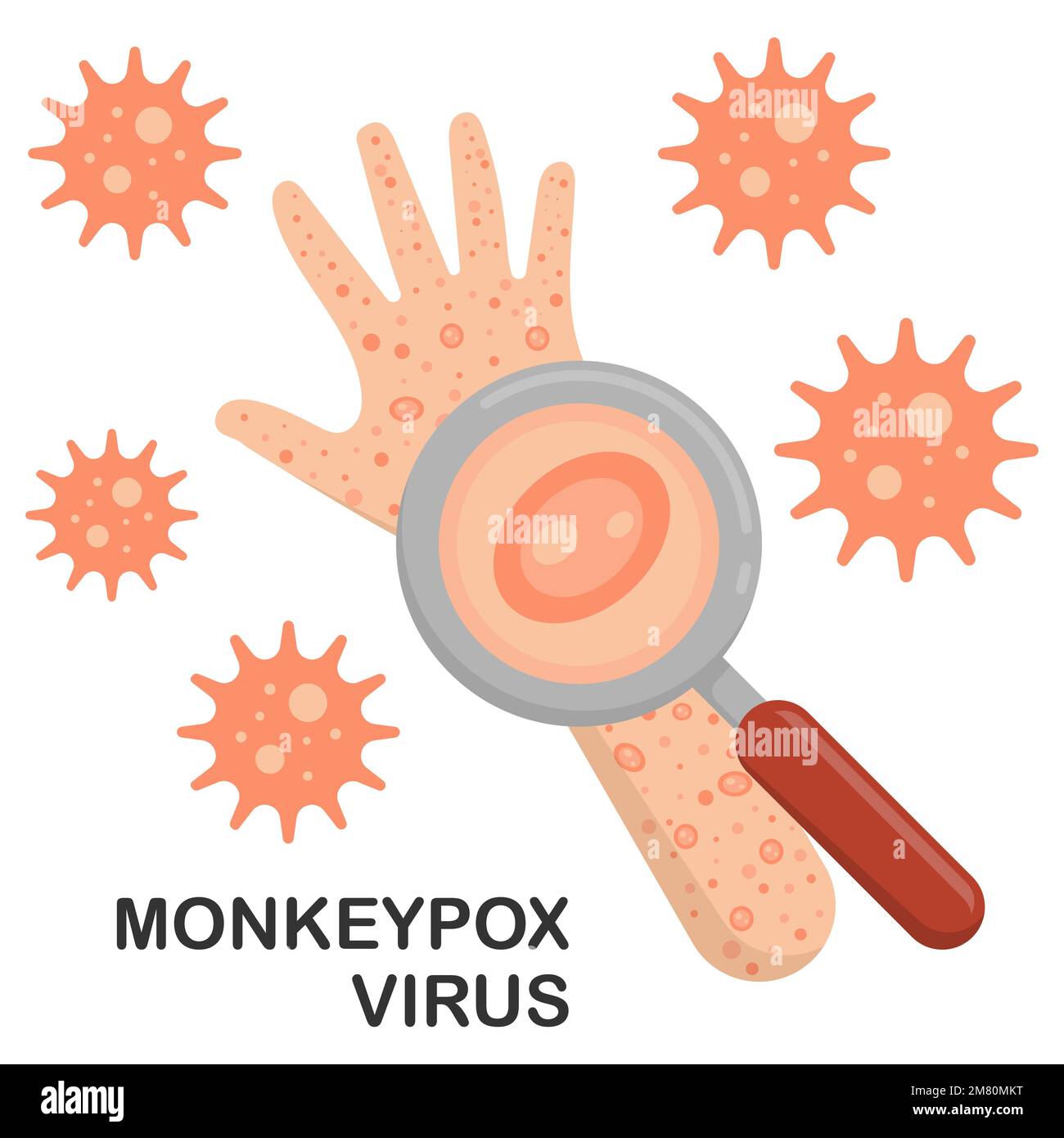 Monkeypox virus on hand and arm. Monkeypox Virus Outbreak as a ...