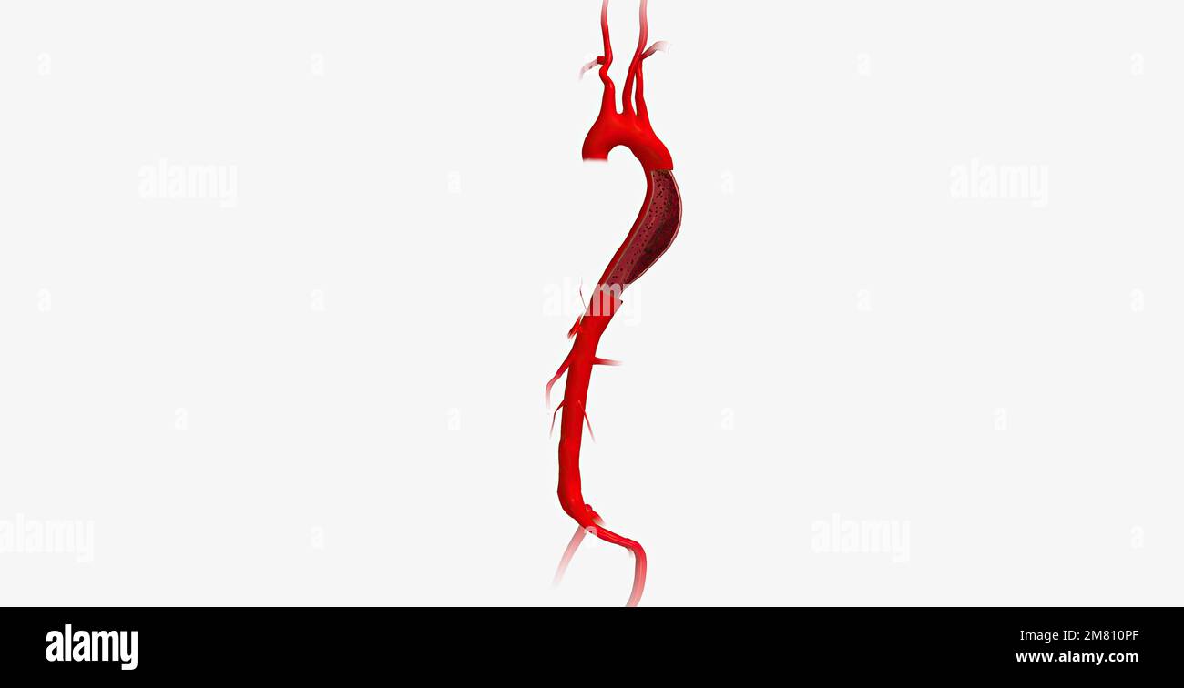 Aorta dissection hi-res stock photography and images - Alamy