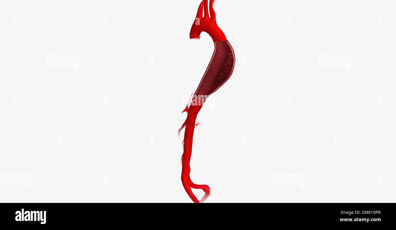 Aortic valve layer hi-res stock photography and images - Alamy