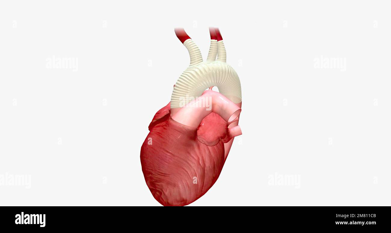 Enlarged heart muscle hi-res stock photography and images - Alamy