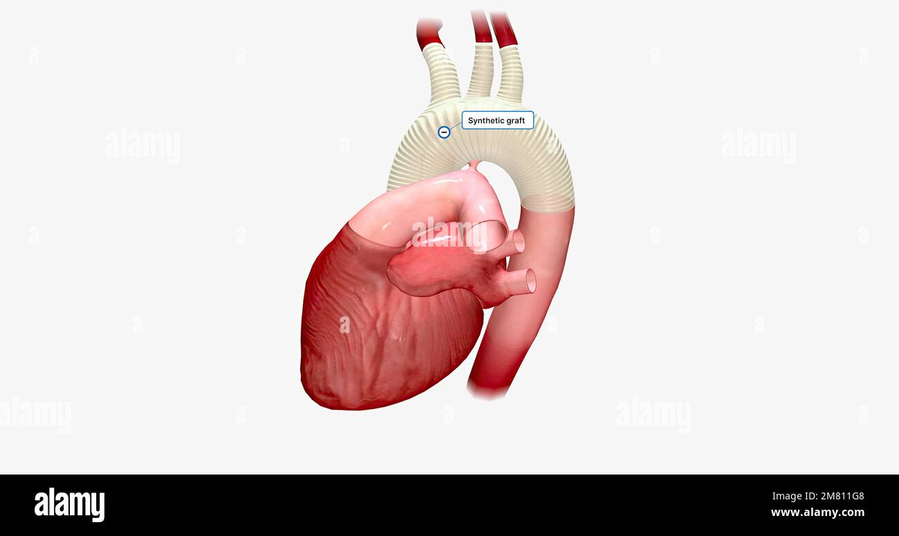 Enlarged heart muscle hi-res stock photography and images - Alamy