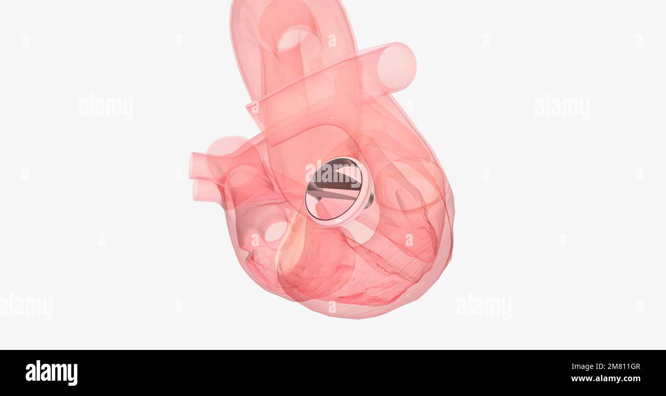 Damaged coronary artery hi-res stock photography and images - Alamy