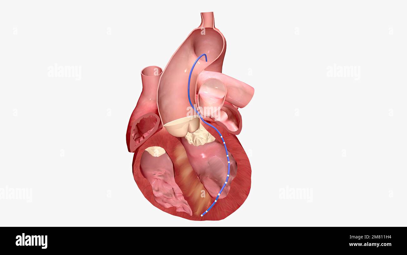 Enlarged heart muscle hi-res stock photography and images - Alamy