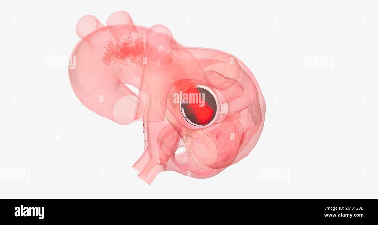 Damaged aortic heart valve hi-res stock photography and images - Alamy