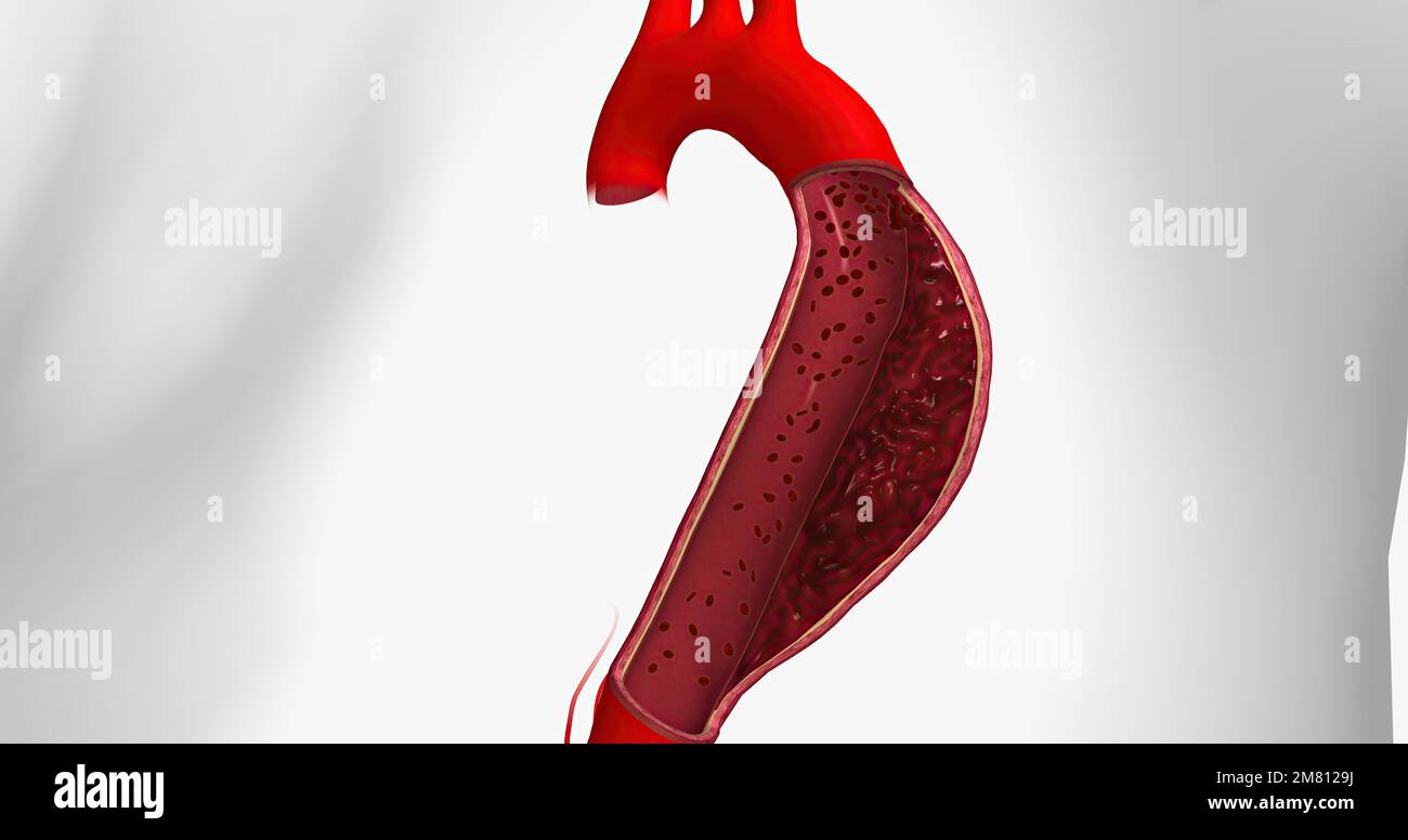 Aorta dissection hi-res stock photography and images - Alamy