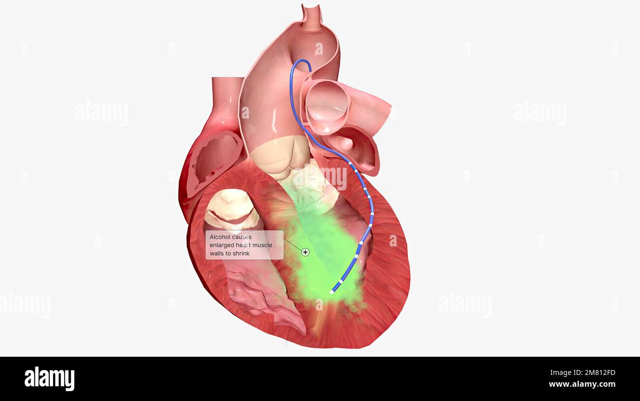 Pure oxygen treatment hi-res stock photography and images - Alamy