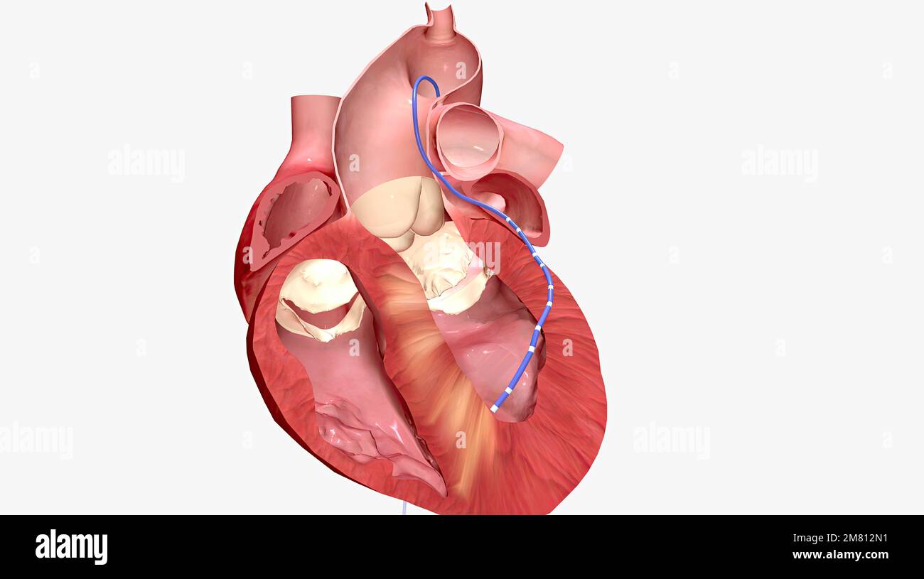 Enlarged heart muscle hi-res stock photography and images - Alamy