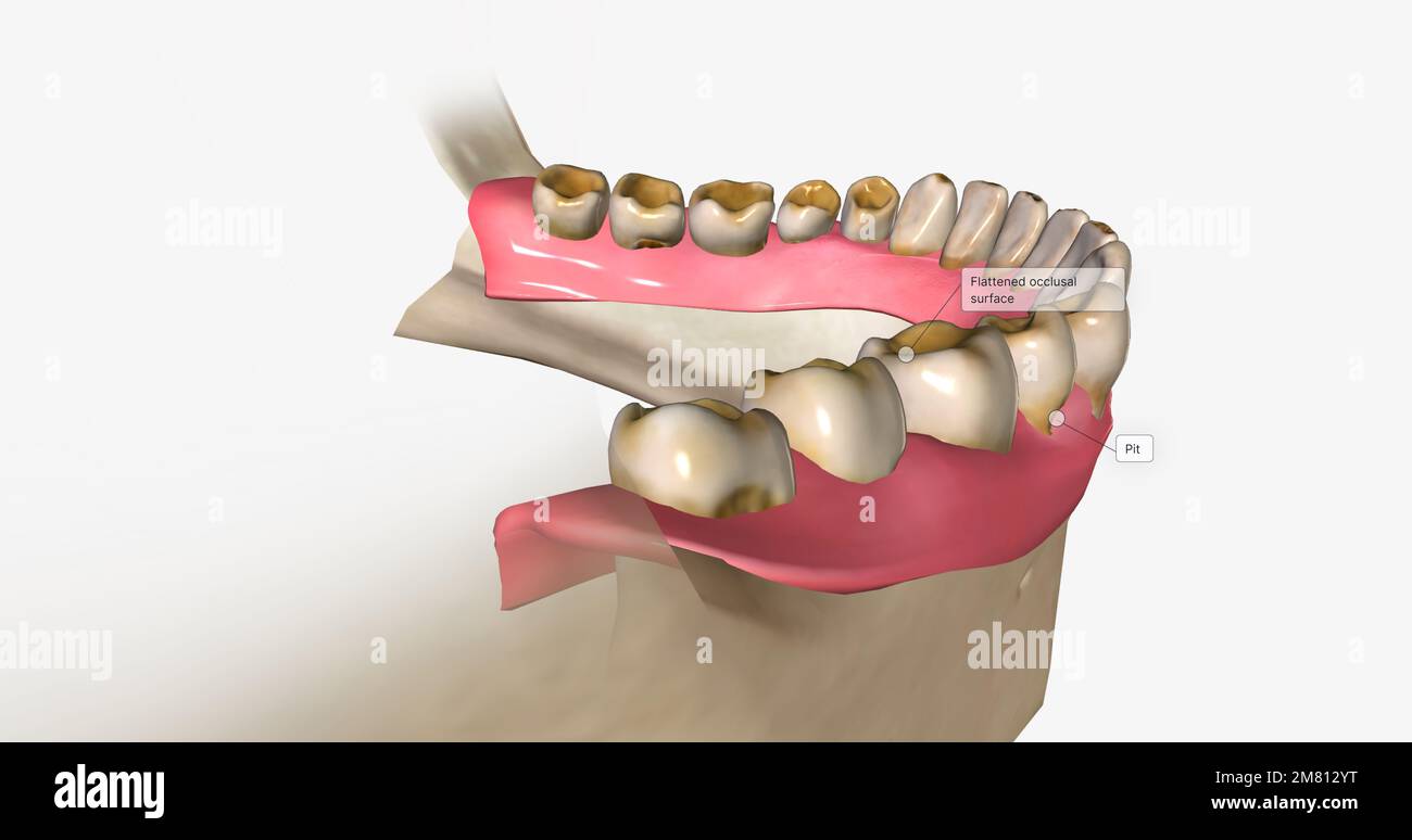 Dental erosion, also known as tooth erosion 3D rendering Stock Photo ...