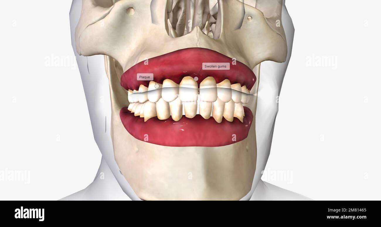 Pulp tender hi-res stock photography and images - Alamy