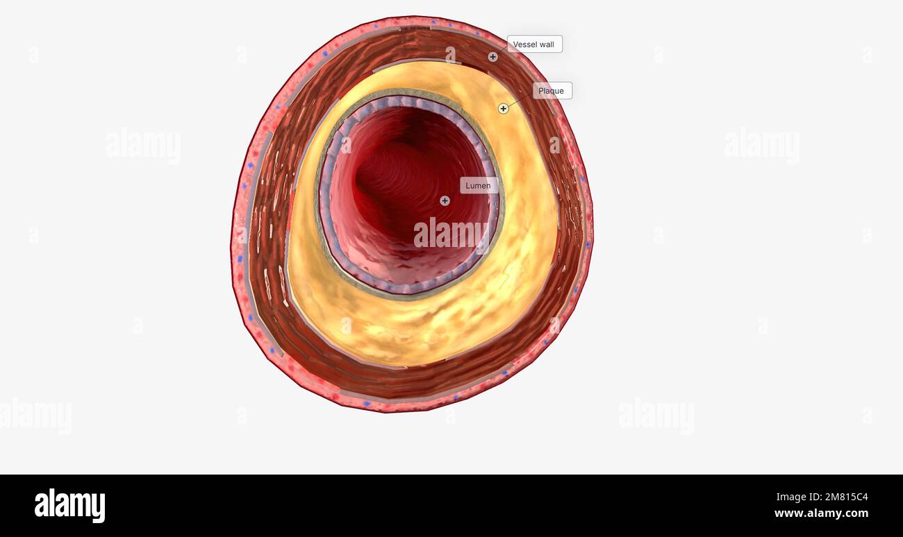 Plaque arterial wall hi-res stock photography and images - Alamy