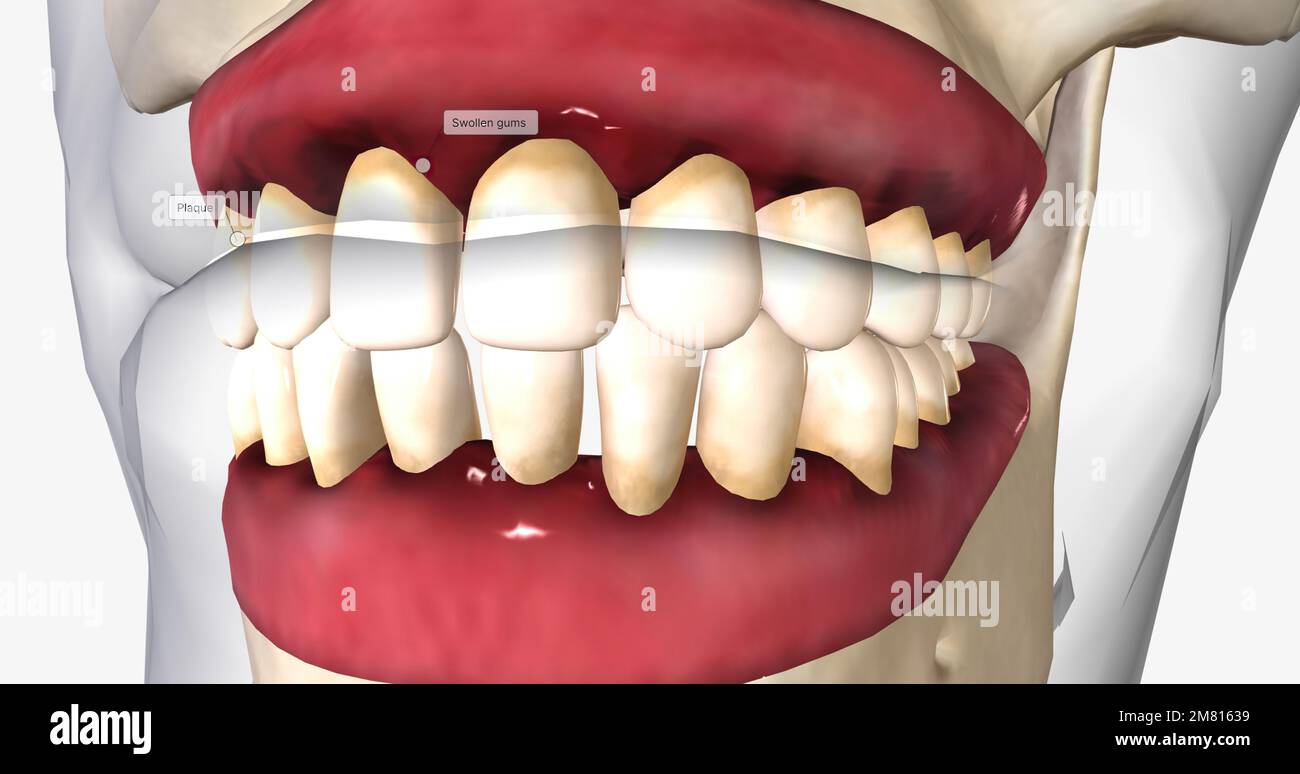 Mild Periodontal Disease