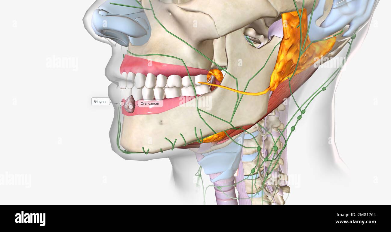 Mouth cancer anatomy hi-res stock photography and images - Alamy