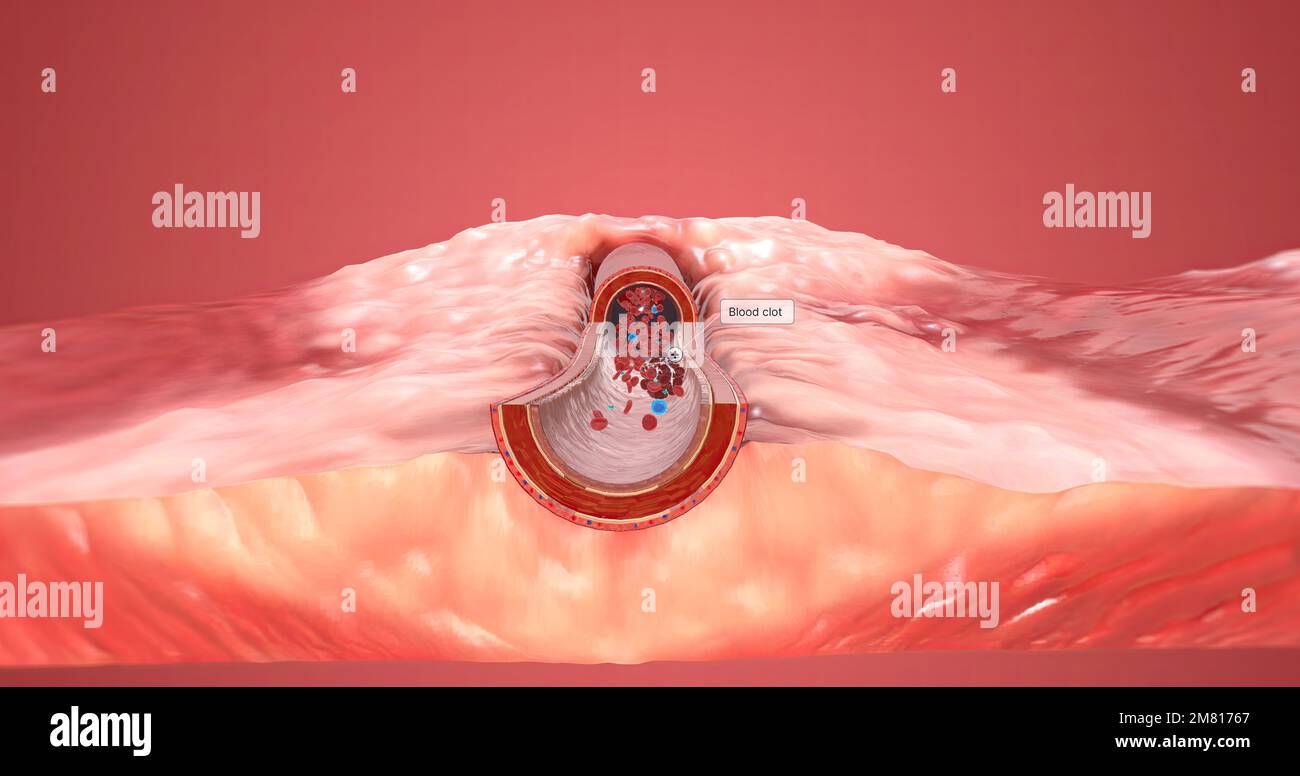 Fibrin red white cells hi-res stock photography and images - Alamy