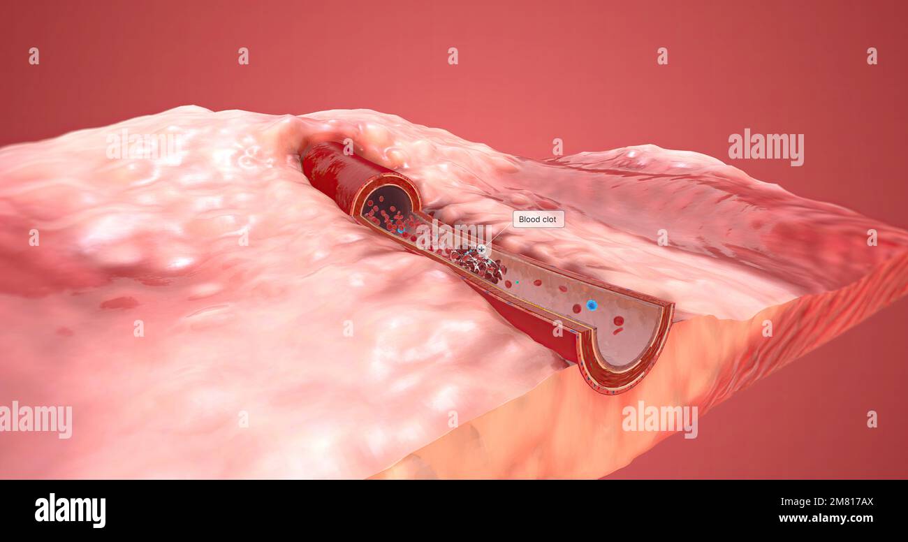 Fibrin red white cells hi-res stock photography and images - Alamy