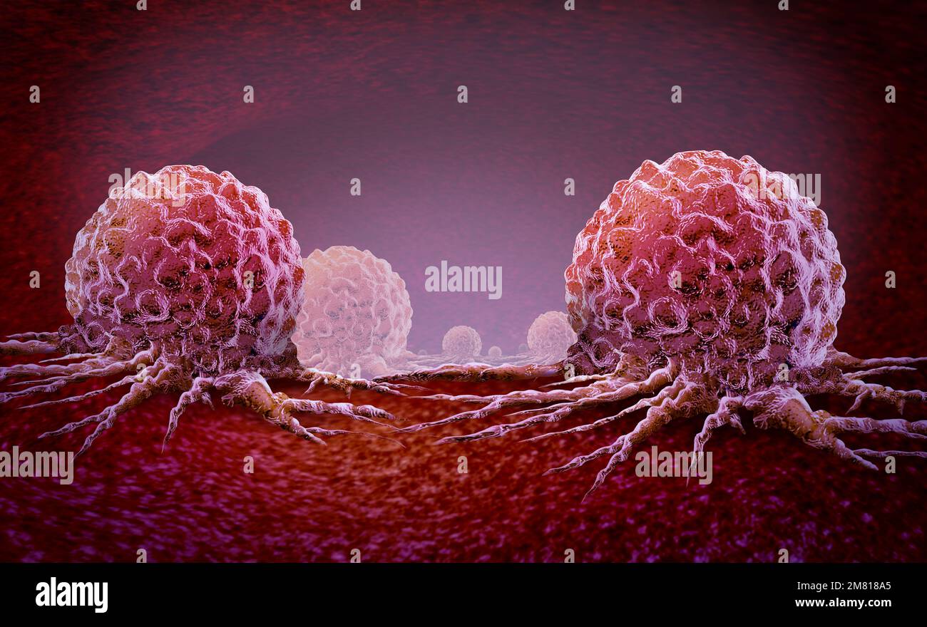 Cancer oncology and Malignant Cancerous Growth and Metastasis anatomy ...