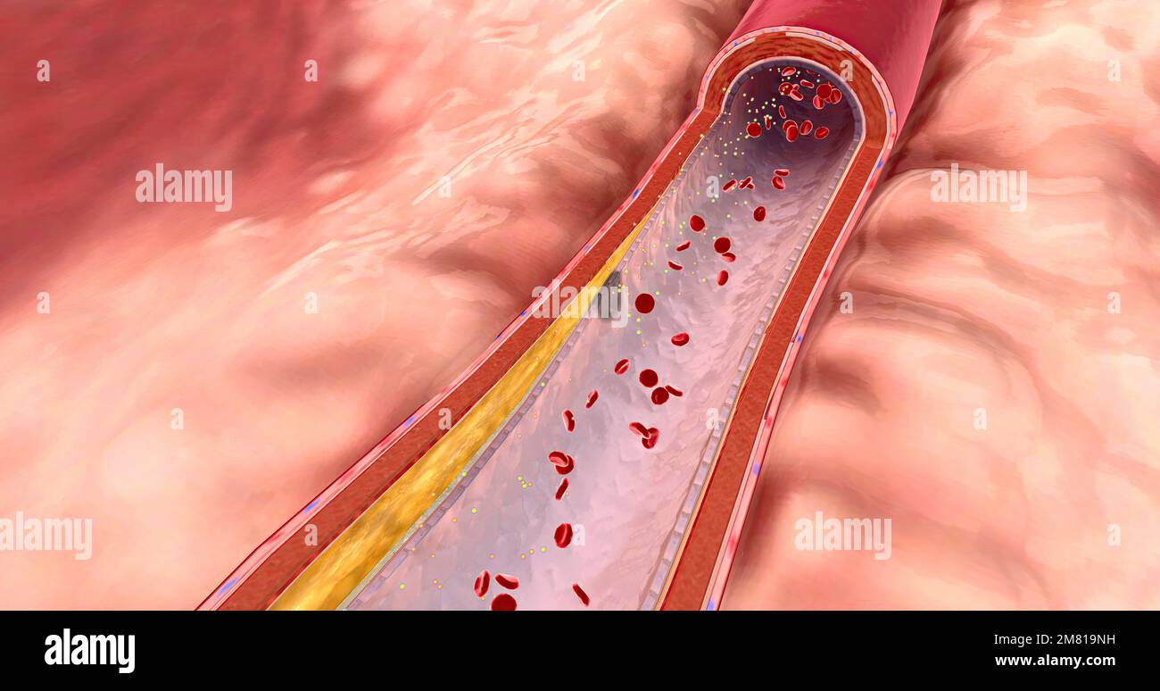 Arteries obstruction hi-res stock photography and images - Alamy