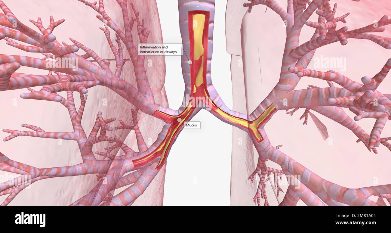 Airway constriction hi-res stock photography and images - Alamy