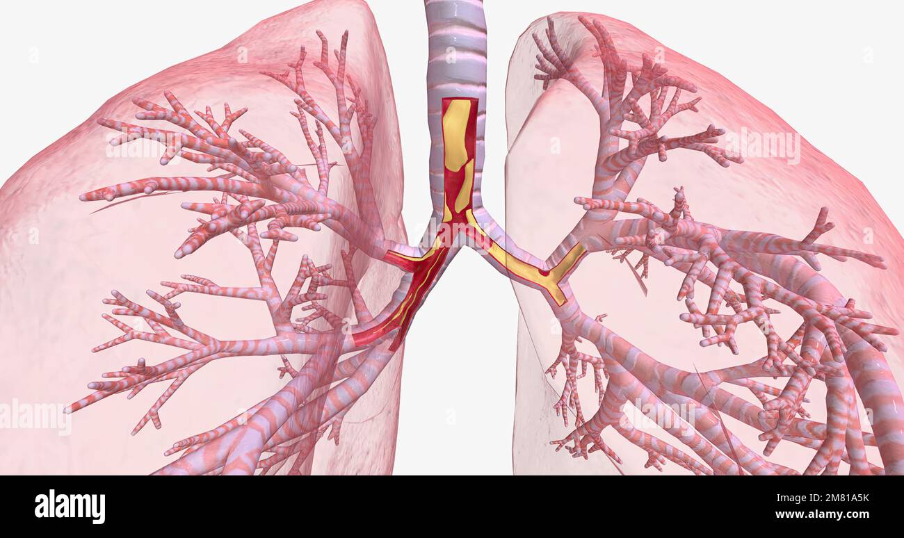 Airway constriction hi-res stock photography and images - Alamy