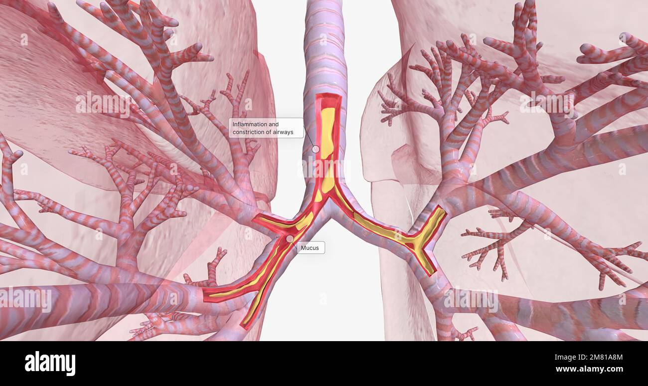 Airway constriction hi-res stock photography and images - Alamy