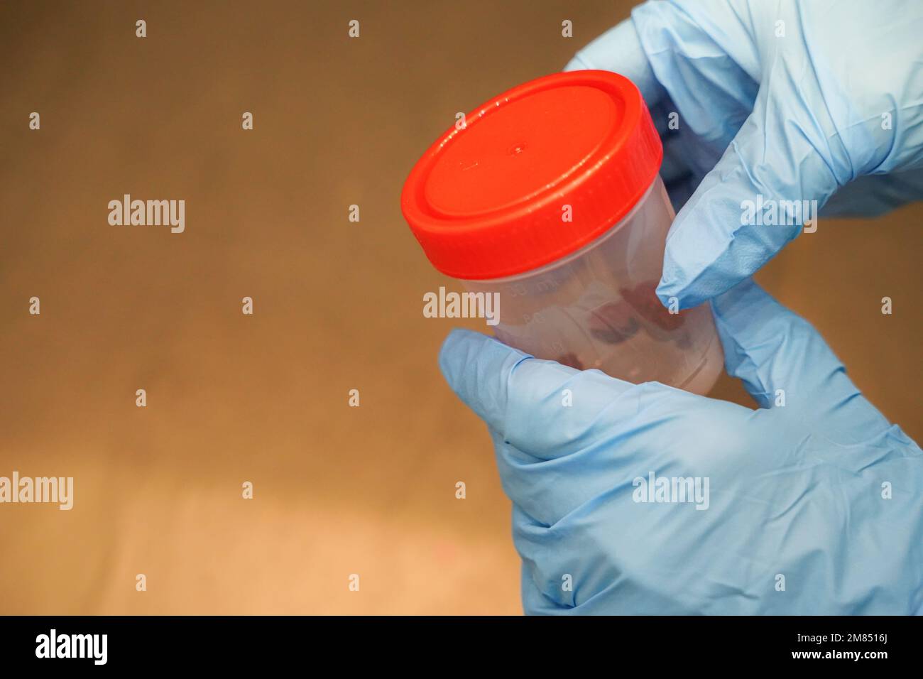 a sample of real stool for analysis in the laboratory. excrement test ...