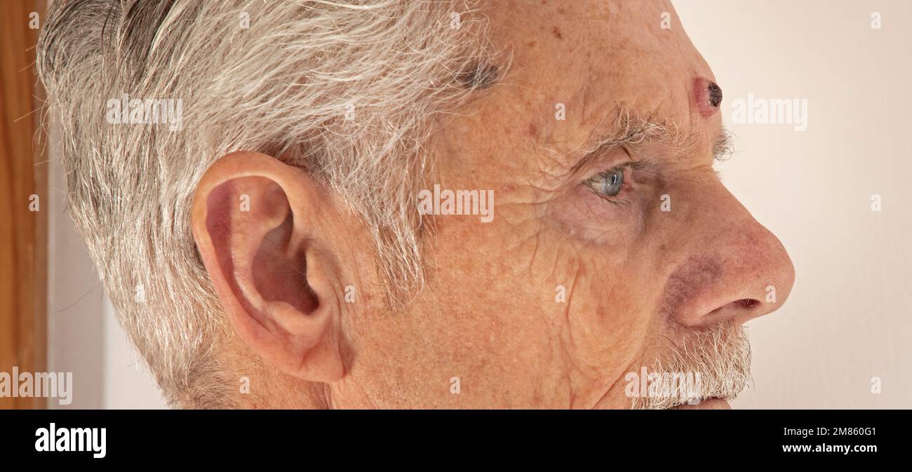 Keratoacanthoma skin cancer growth on a male forehead. Keratoacanthoma ...