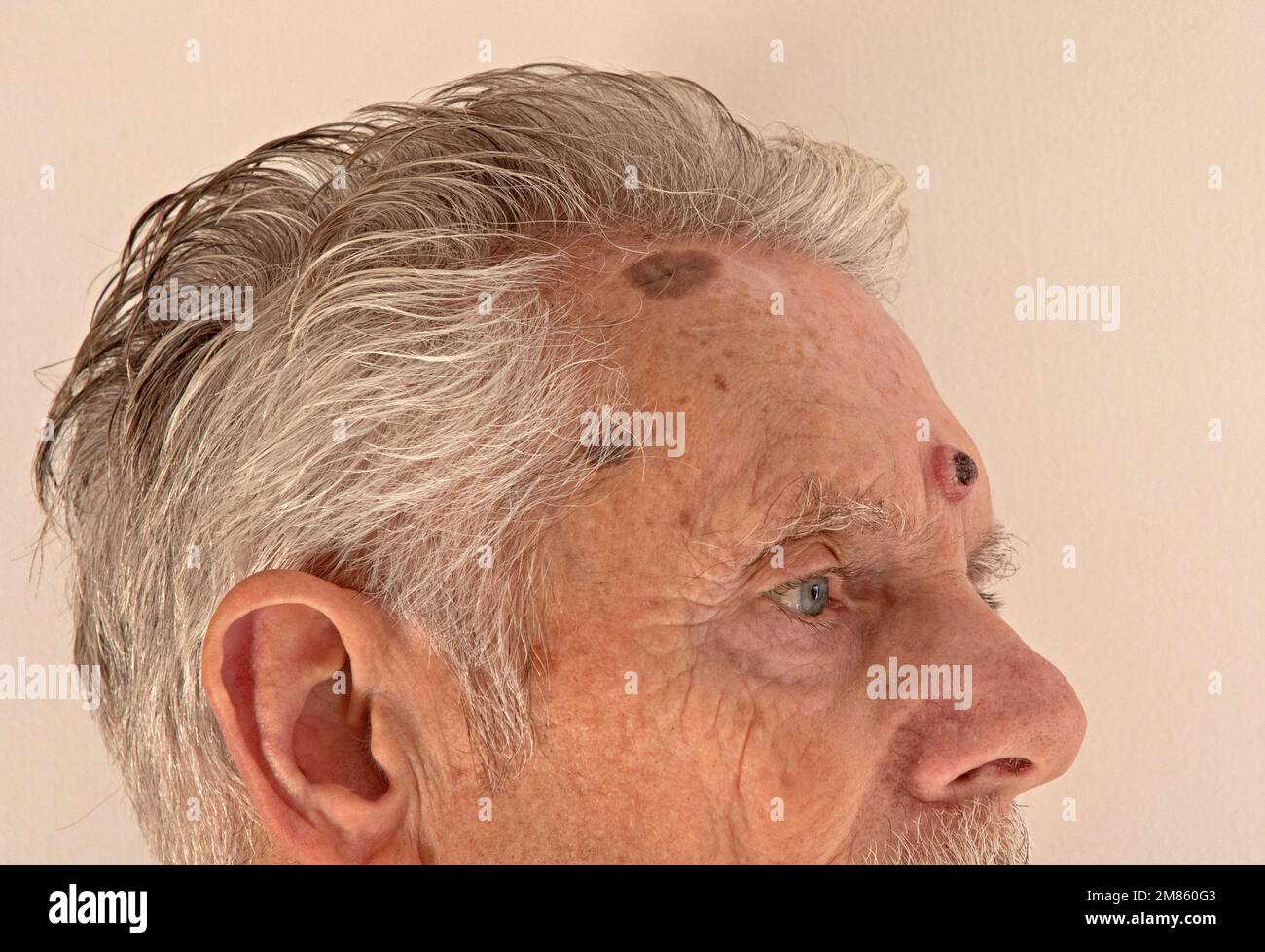 Keratoacanthoma Skin Cancer Growth On A Male Forehead Keratoacanthoma Is A Low Grade Rapidly