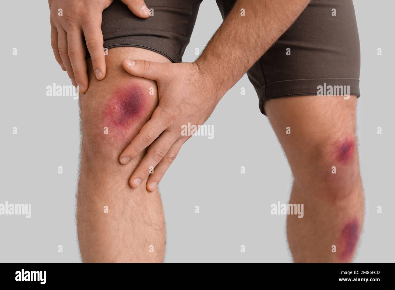 Man with bruises on legs against light background, closeup Stock Photo ...