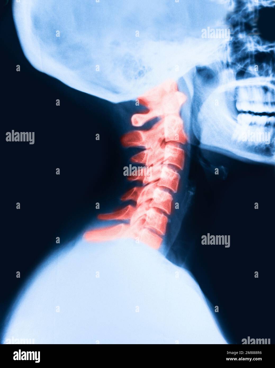 Woman skull xray hi-res stock photography and images - Alamy