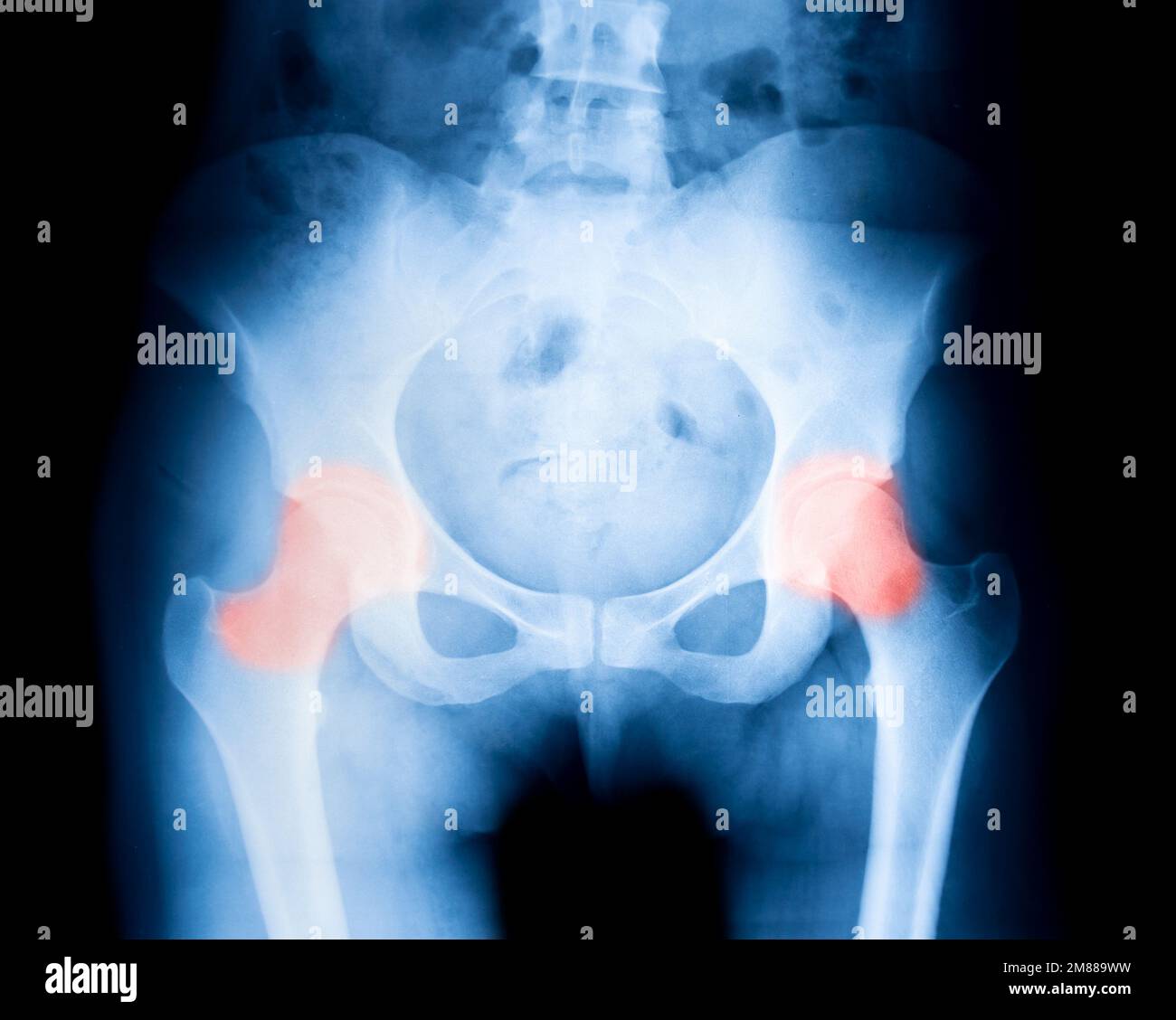 X-ray close up pelvic bone with pain symptoms in joints Stock Photo - Alamy