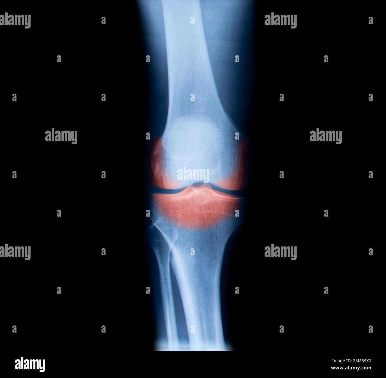 Osteoarthritis of the knee hi-res stock photography and images - Alamy