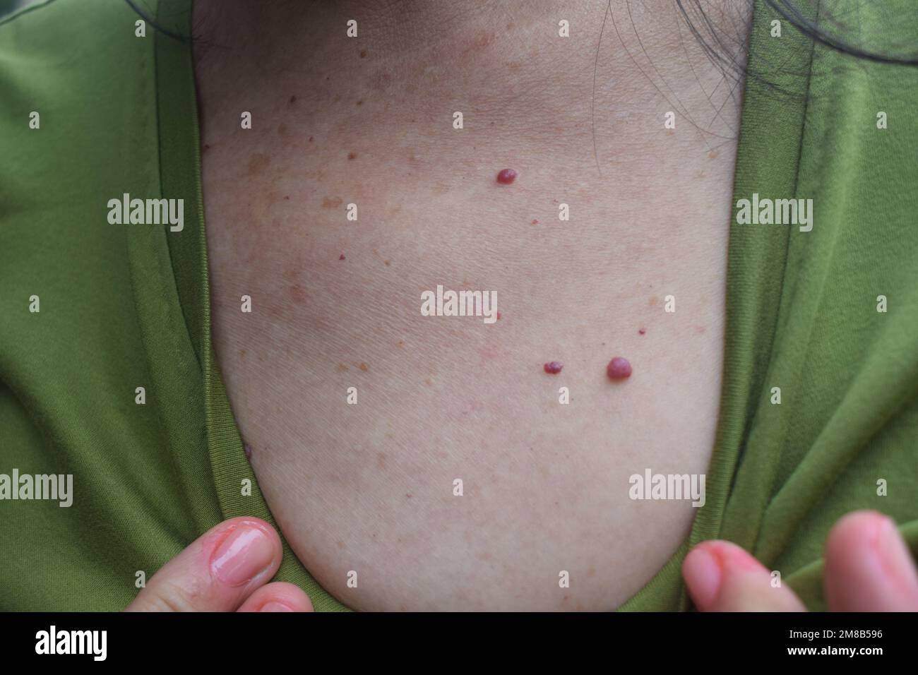 Chest moles hi-res stock photography and images - Alamy
