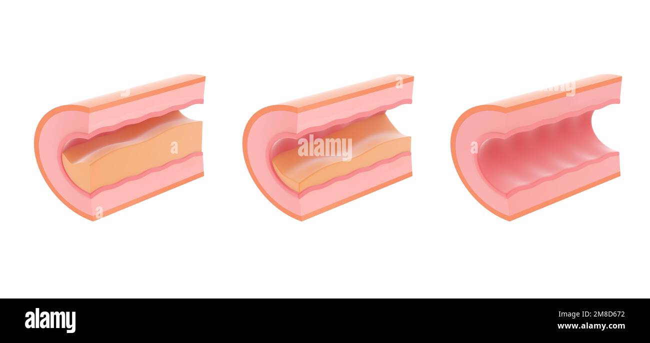 Anatomical 3d illustration clogged and healthy capillary vessel. Three ...